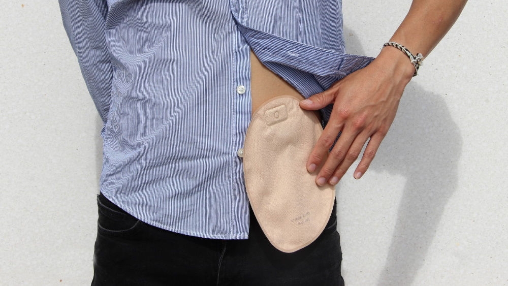 Qu’est-ce qu’une stomie ? Explication de la fonction et des types de ...