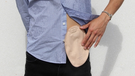 Qu’est-ce qu’une stomie ? Explication de la fonction et des types de ...